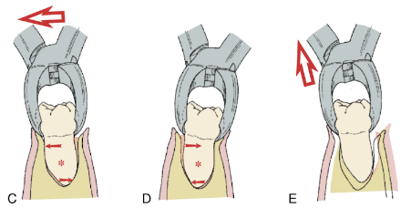 Ekstraksi Gigi Sulung