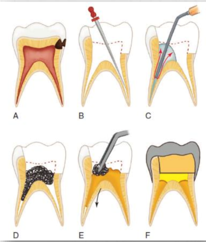 Perawatan Pulpa Gigi Sulung