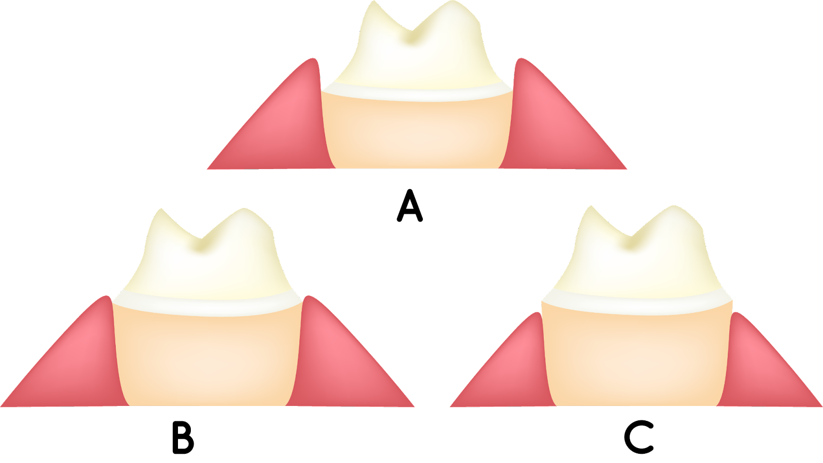 Gigi Tiruan Jembatan