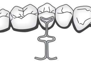 Lebih Paham Tentang Komponen Aktif Alat Ortodonti Lepasan (AOL)