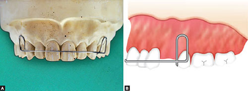 Lebih Paham Tentang Komponen Aktif Alat Ortodonti Lepasan (AOL)