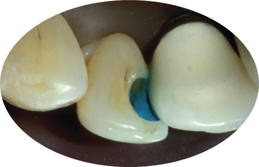 Pahami Tahapan Restorasi Gigi Anterior : Musuh Bebuyutan Koas FKG!