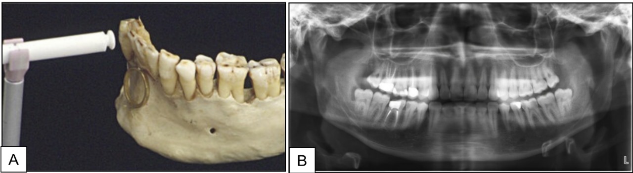 Kupas Tuntas Teknik Rontgen Panoramik!