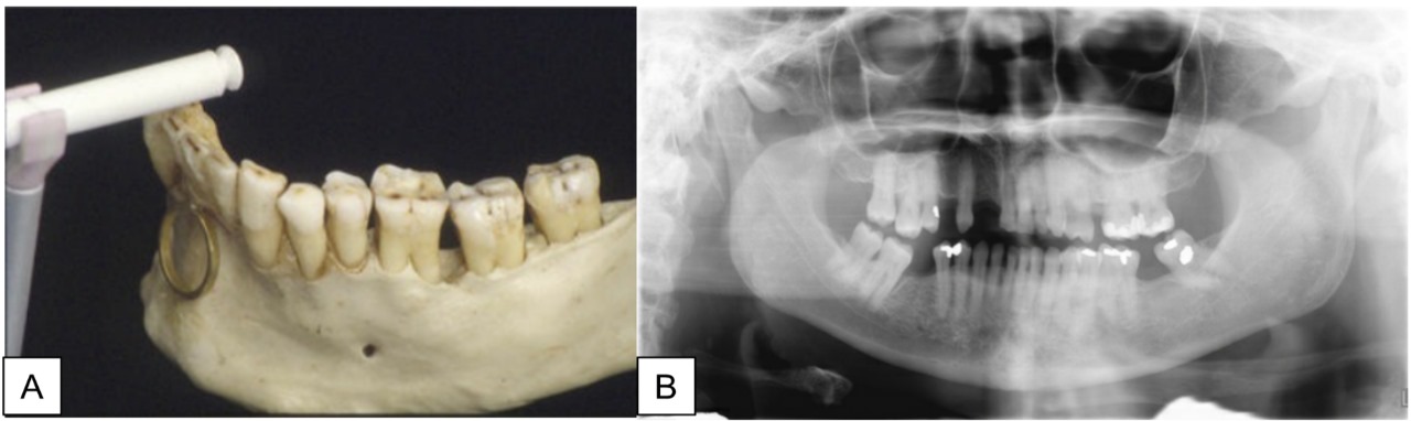 Kupas Tuntas Teknik Rontgen Panoramik!