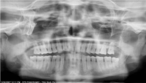 Kupas Tuntas Teknik Rontgen Panoramik!