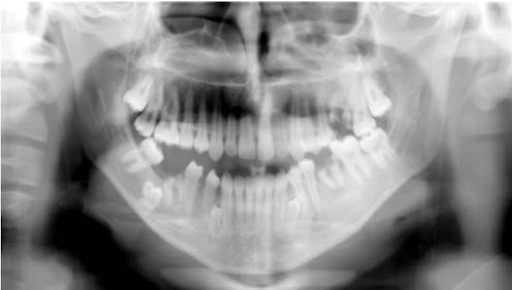 Kupas Tuntas Teknik Rontgen Panoramik!