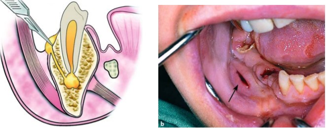 Wajib Paham Prosedur Insisi Abses : Sering Banget Jadi Pertanyaan Anak FKG!