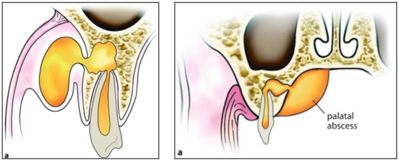 Wajib Paham Prosedur Insisi Abses : Sering Banget Jadi Pertanyaan Anak FKG!