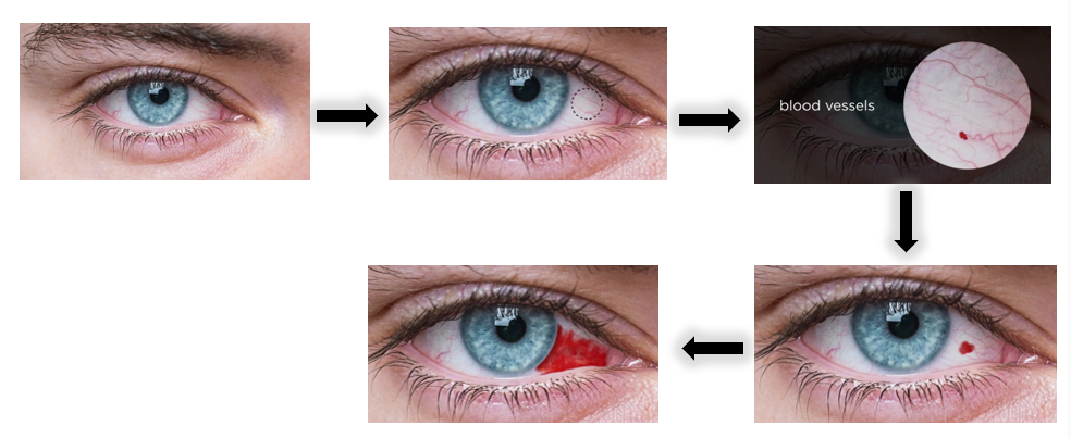 Perdarahan Subconjunctiva